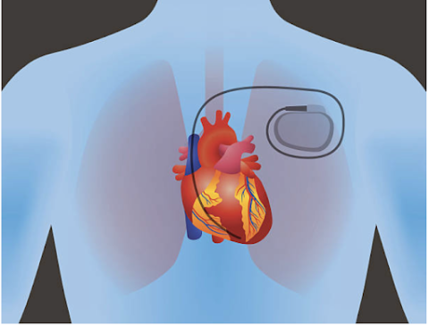 Permanent pacemakers: Why they’re needed and what to expect during surgery